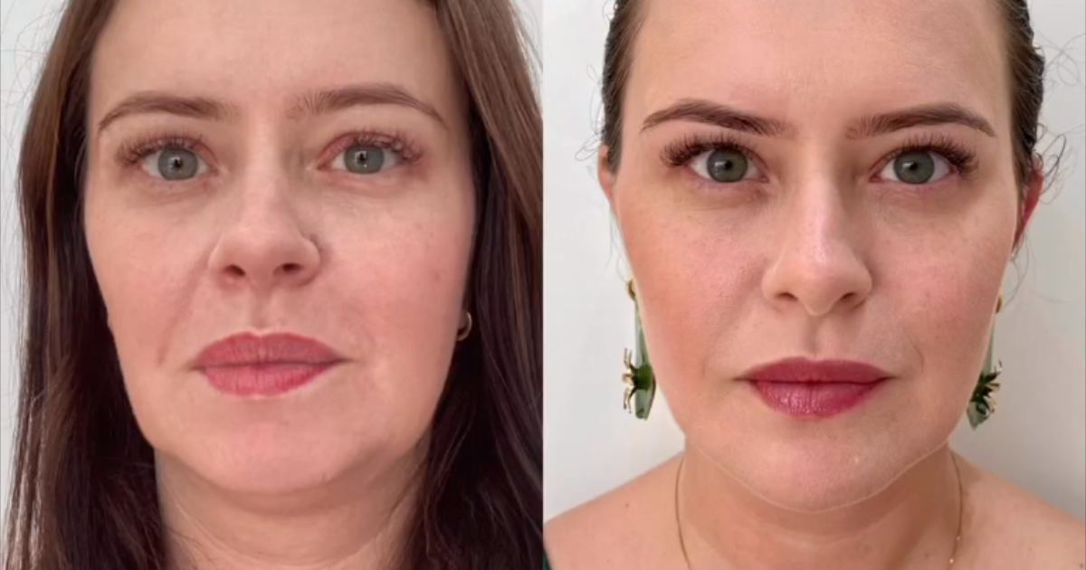 Mari Bridi antes e depois da harmonização facial - Purepeople