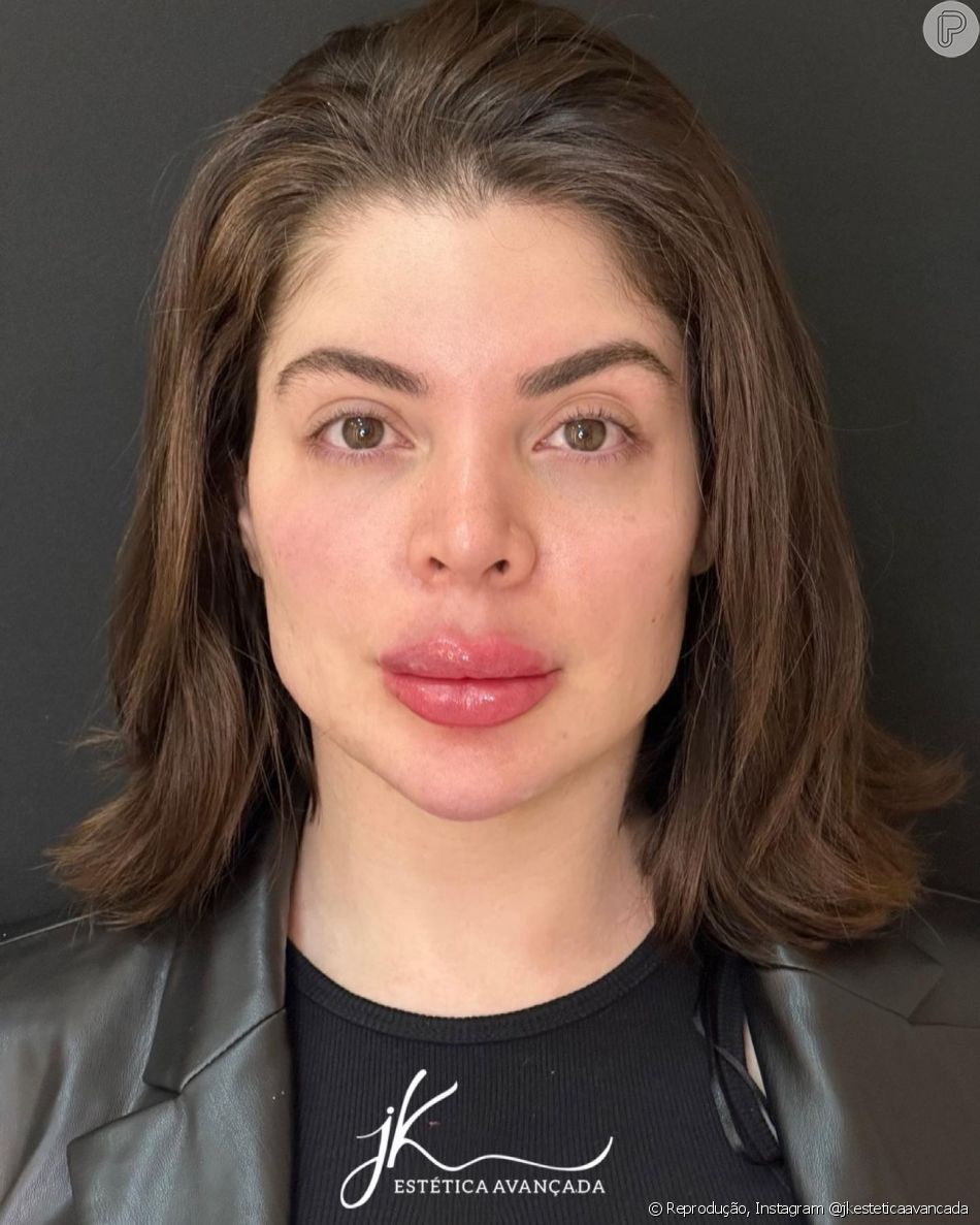 Harmonização facial de Gkay tem antes e depois surpreendente!: fotos ...