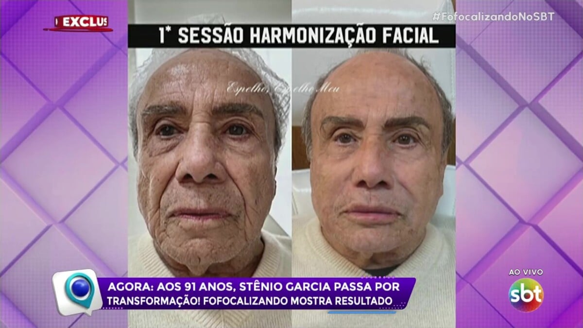 Foto: Harmonização facial de Stenio Garcia: ator realizou uma série de ...