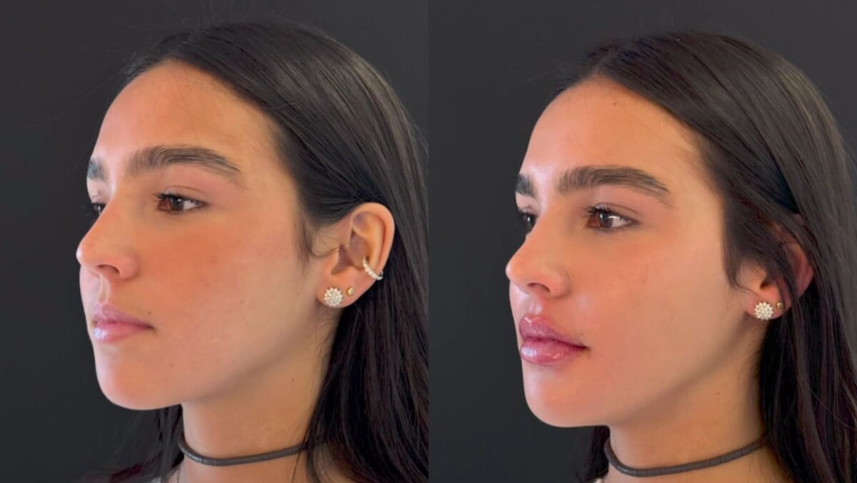 Foto: Harmonização facial de Duda Guerra arrebitou a ponta do nariz e ...