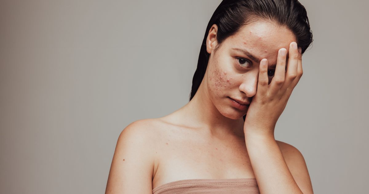 Cuidar da pele com acne no verão é essencial para evitar marcas e ...