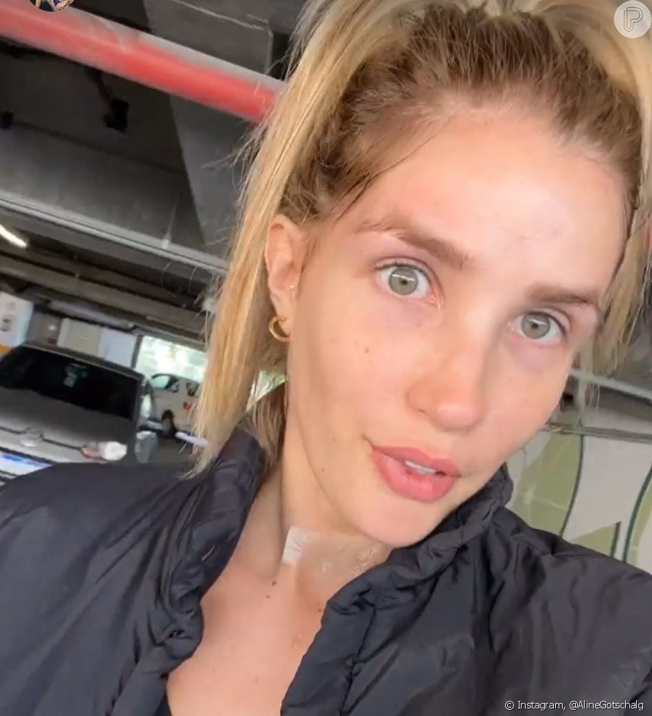 Aline Gotschalg antes e depois do câncer: ex-BBB revela tratamento após ...