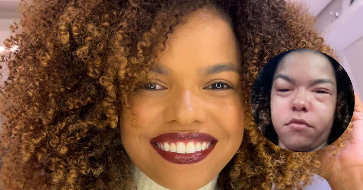 Jeniffer Nascimento tem rosto deformado por grave alergia alimentar ...