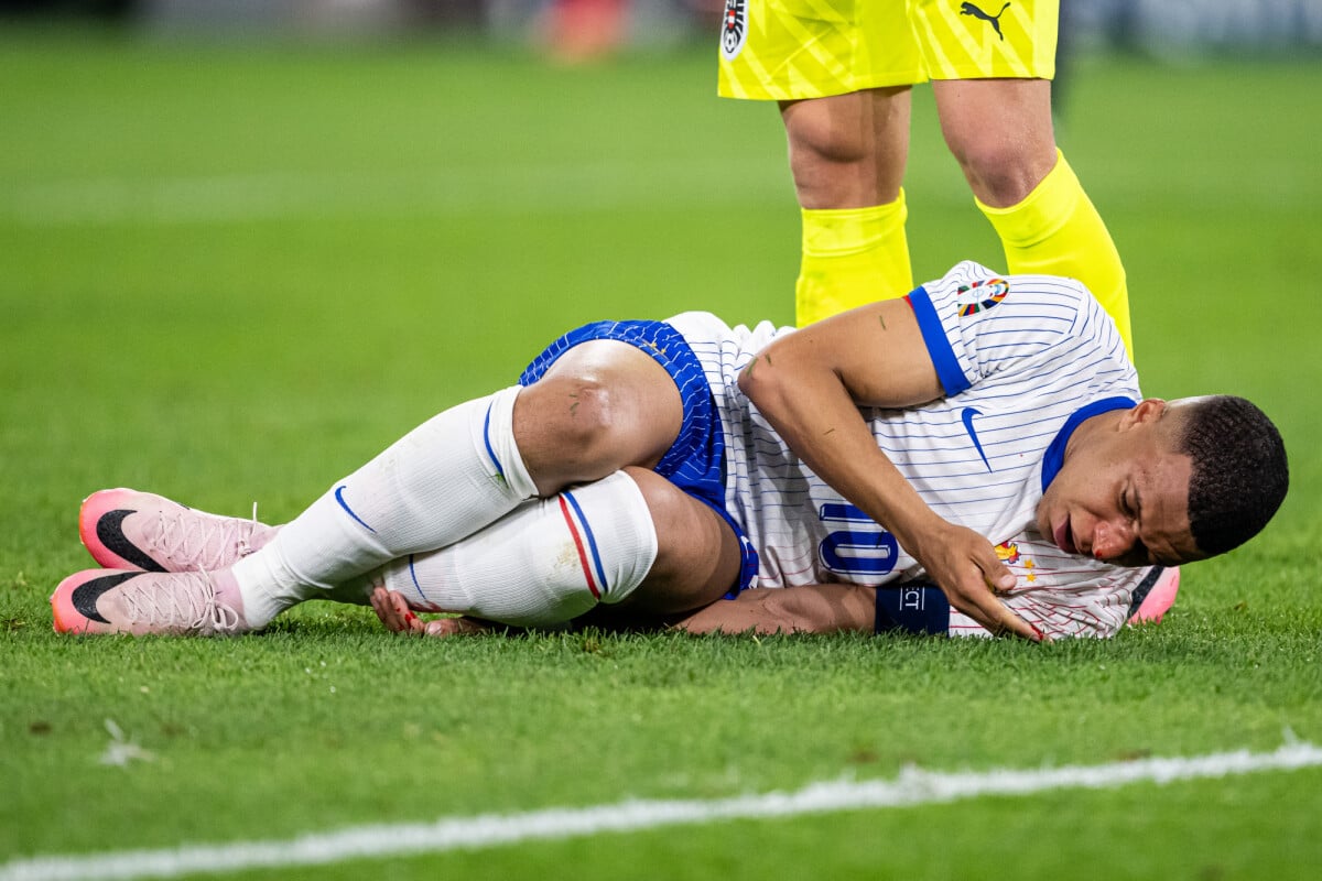 Foto: Atacante da seleção francesa, Mbappé machucou o nariz 'feio' e ...