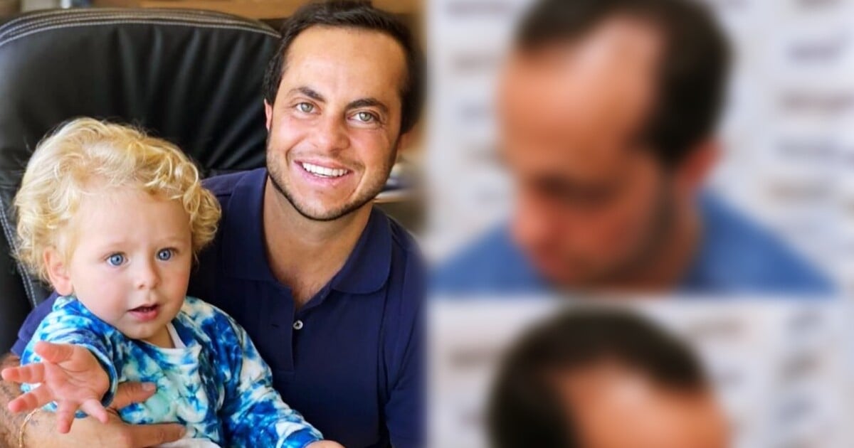 Thammy Miranda faz transplante capilar e o antes e depois do cabelo do ...