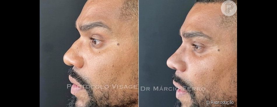 Naldo Benny sofre princípio de necrose no nariz após problema em ...