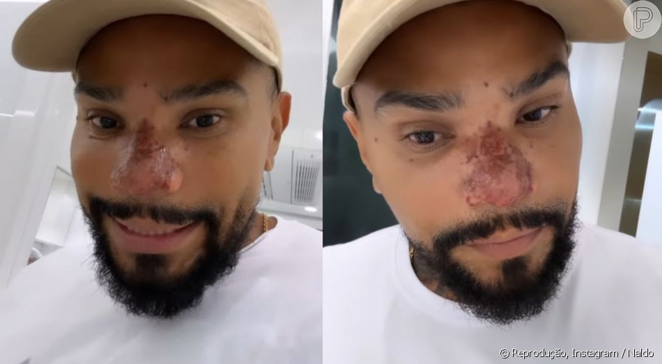 Naldo Benny sofre princípio de necrose no nariz após problema em ...