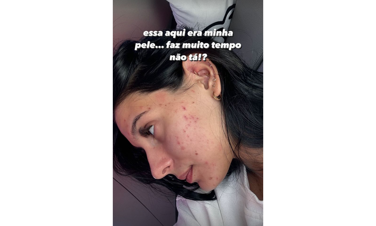 Foto: Ana Castela destacou, em uma sequência de imagens, sua pele ...