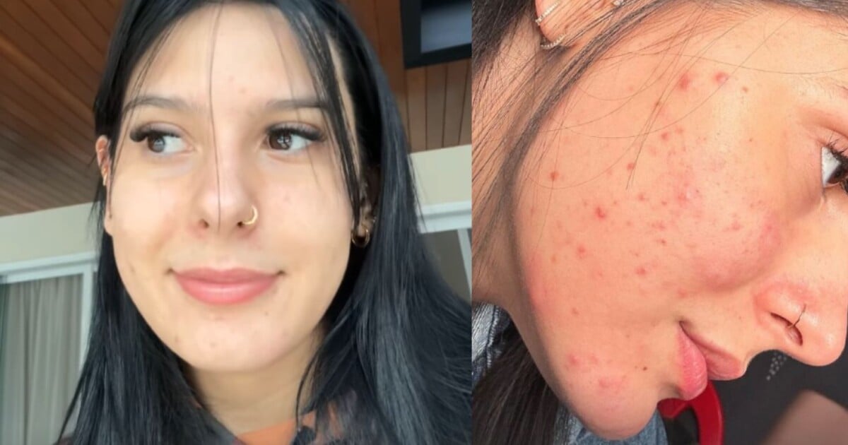 Antes e depois de Ana Castela: sertaneja faz tratamento contra acne e ...