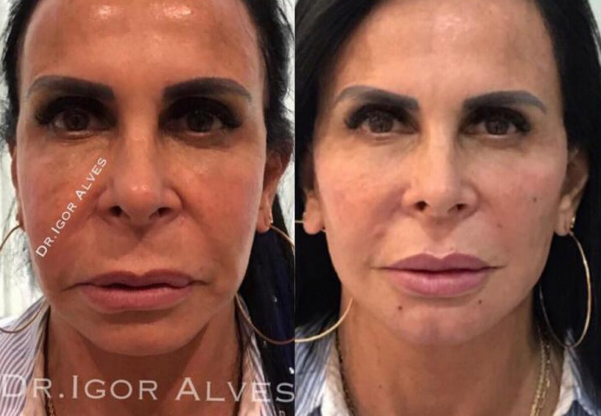 Foto: Gretchen antes e depois da harmonização facial - Purepeople