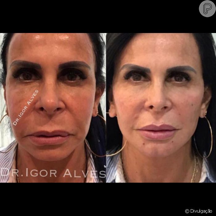 Gretchen antes e depois da harmonização facial - Purepeople