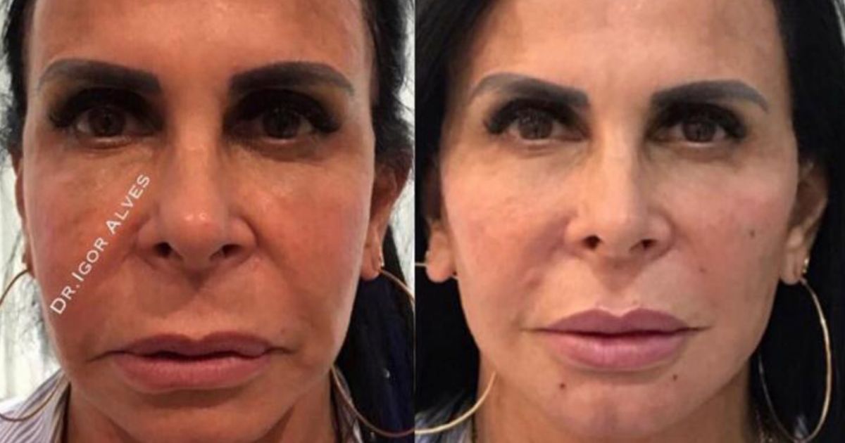 Gretchen antes e depois da harmonização facial - Purepeople