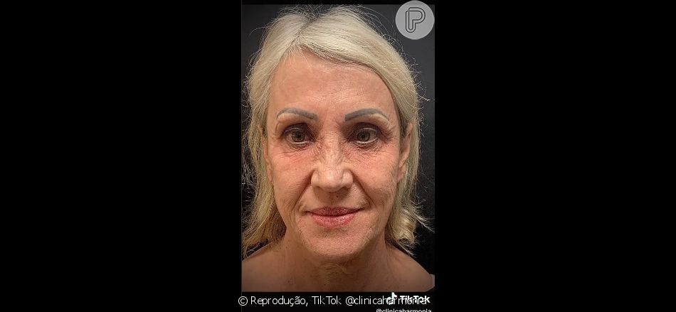 Peeling de fenol: antes e depois viraliza no Tik Tok e médico explica ...