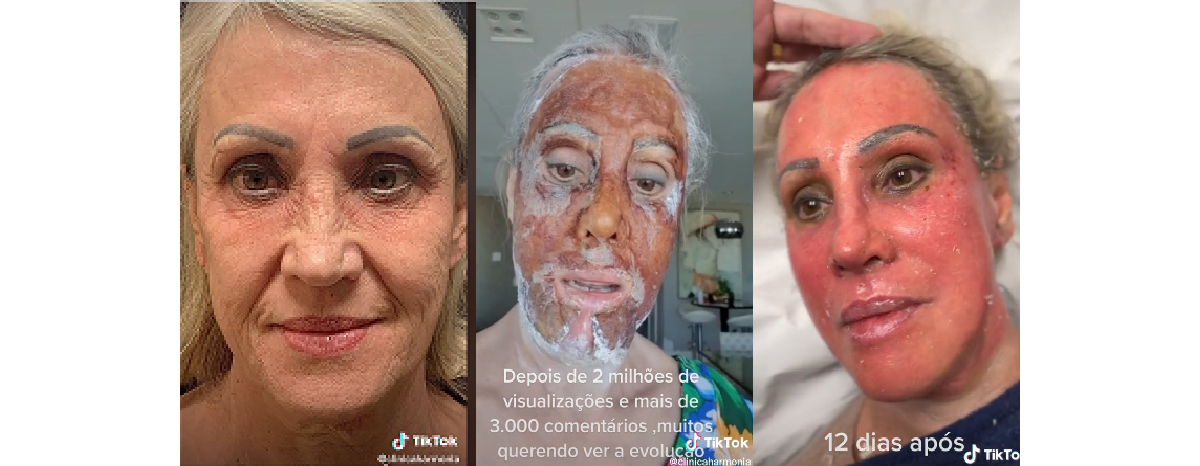 Foto: O peeling de fenol protagoniza um vídeo viral no Tik Tok: antes e ...