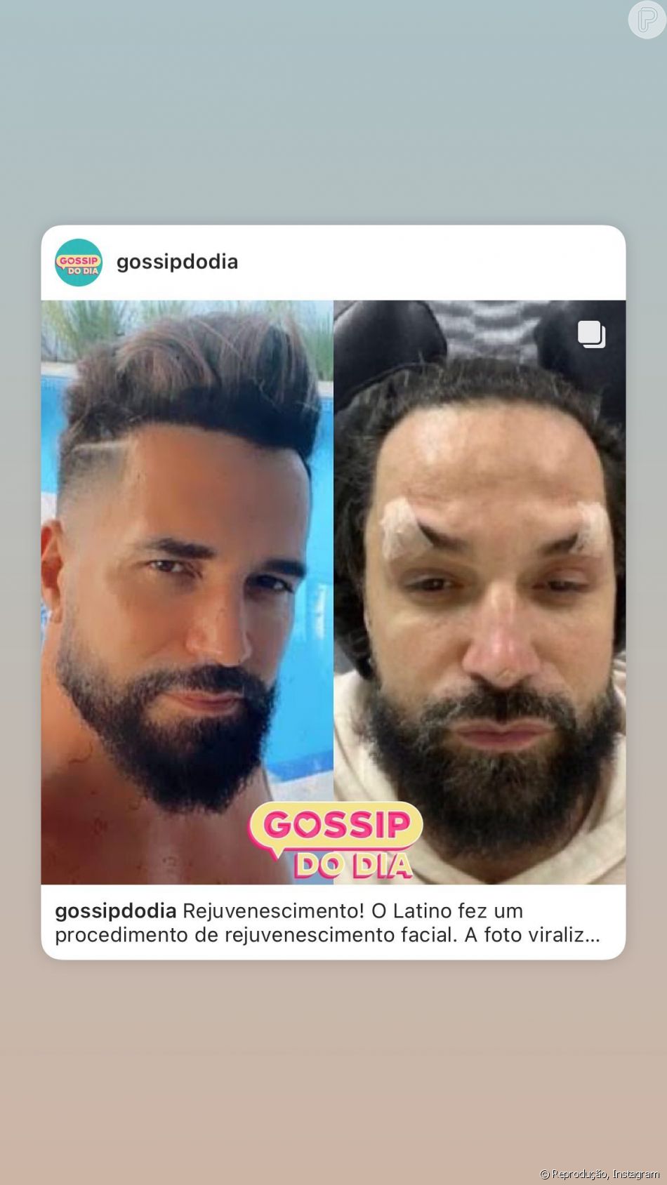Rosto de Latino após procedimento estético choca a web e cantor explica ...
