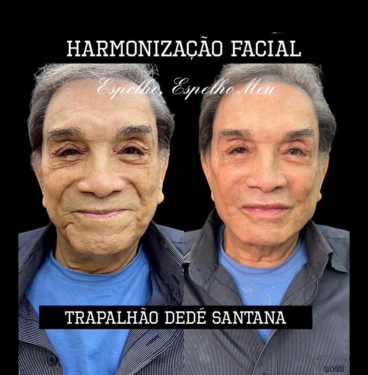 Foto: Dedé Santana antes e depois da harmonização facial - Purepeople