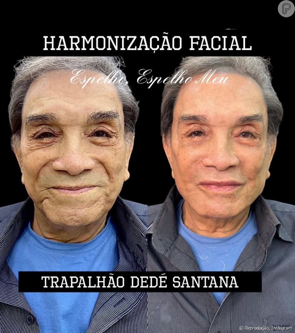 Fotos: Dedé Santana antes e depois da harmonização facial! Veja ...