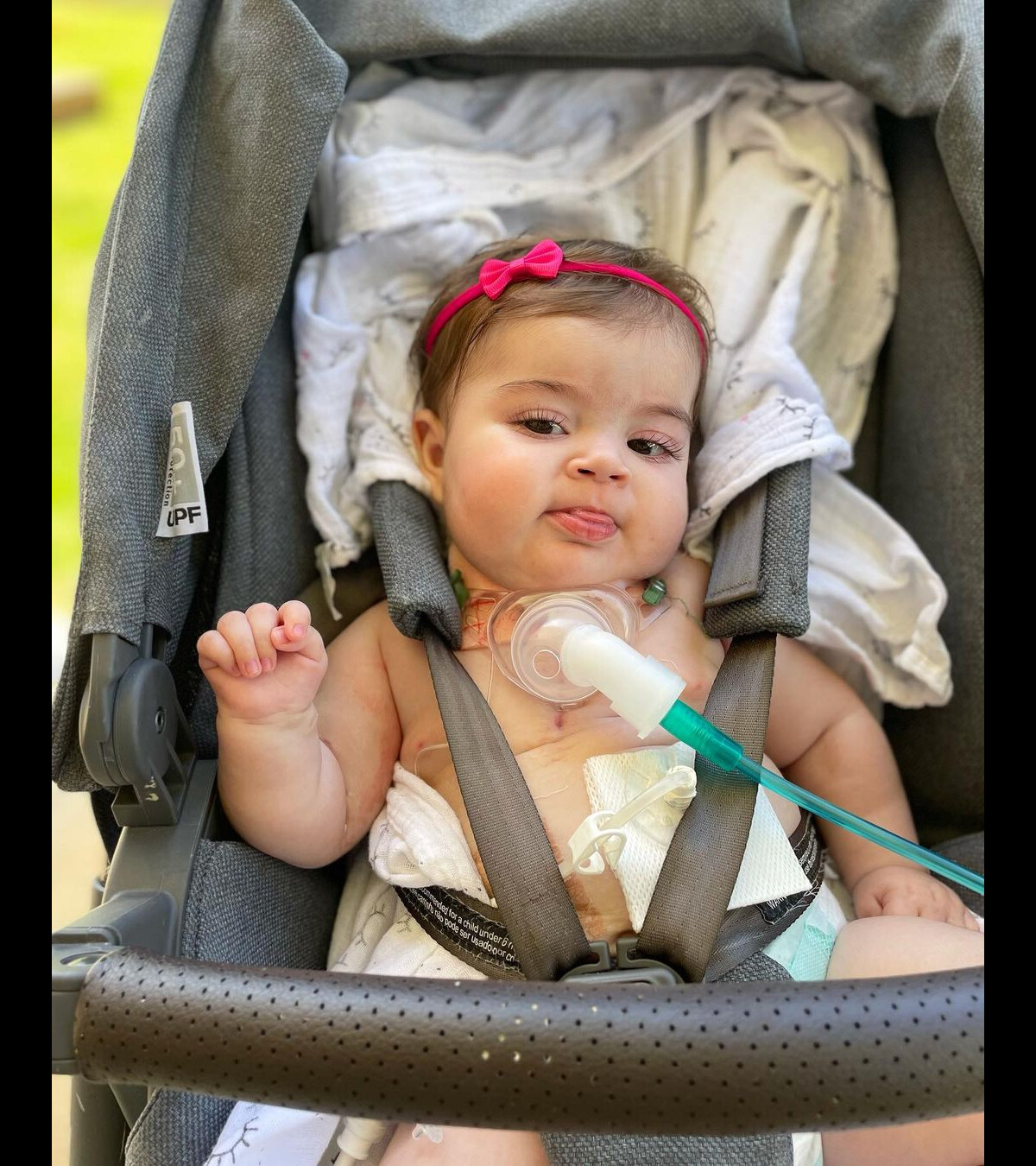 Foto: Maria Guilhermina nasceu com um dos casos mais raros de Anomalia ...