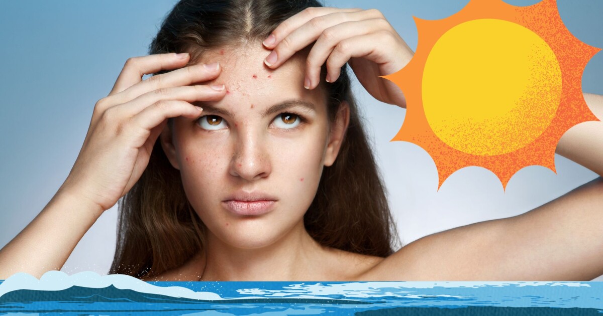 Pele com acne no verão: dermatologista lista cuidados essenciais para ...