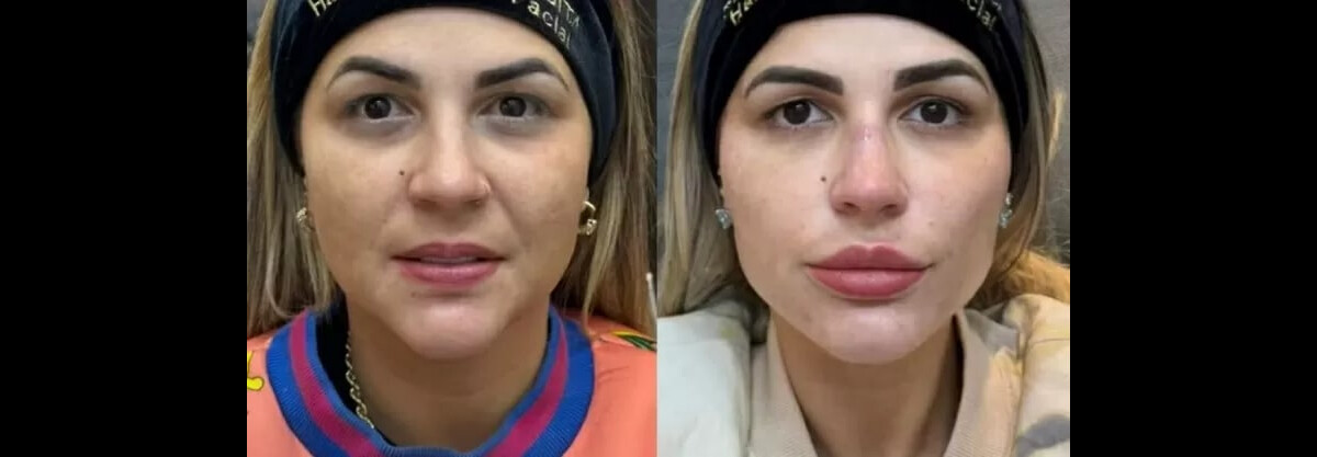Foto: Novo antes e depois de Deolane Bezerra impressionou internautas ...