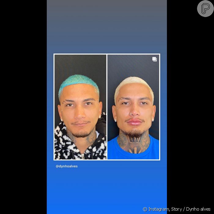 Dynho Alves antes e depois da harmonização facial - Purepeople