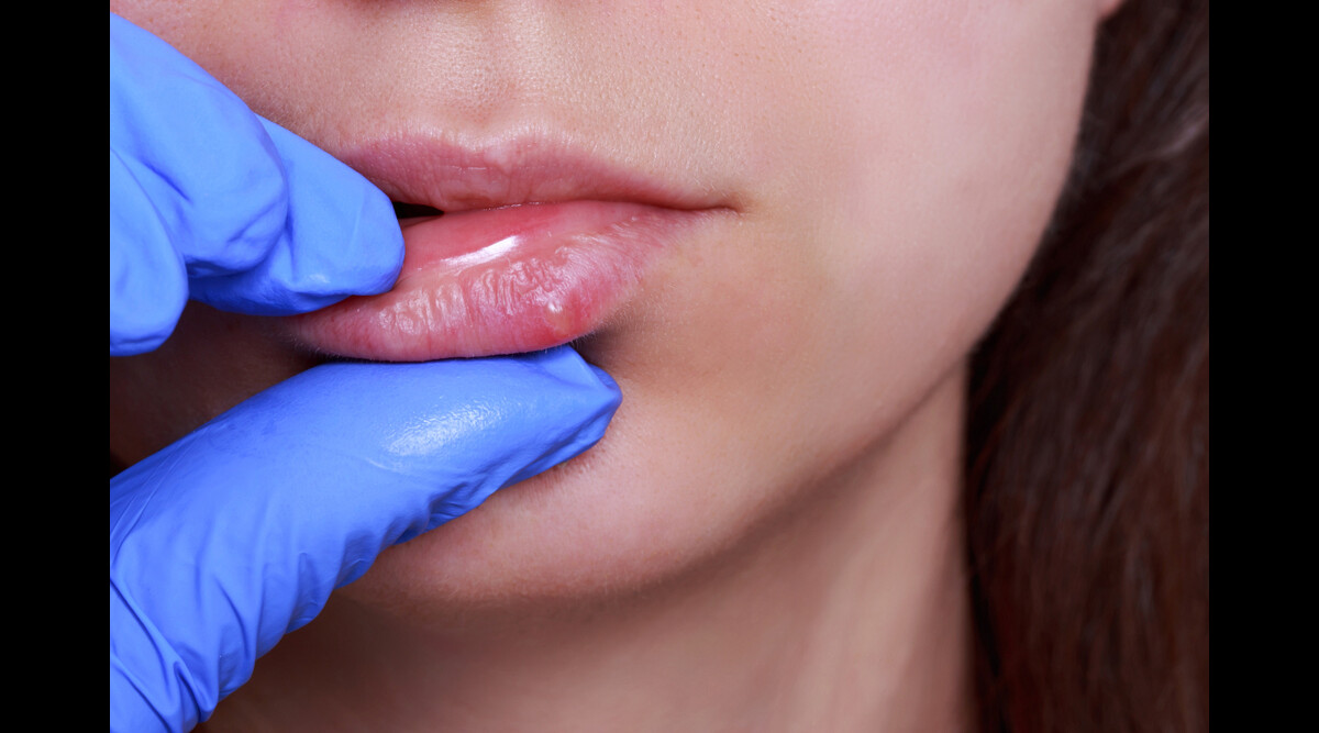 Foto: Herpes labial: um dos sintomas é o aparecimento de bolhas na boca ...