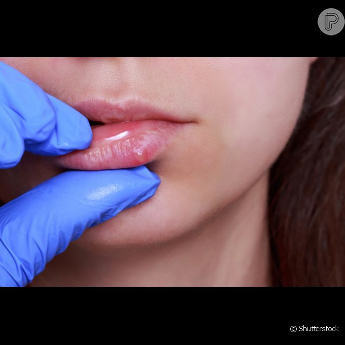 Herpes labial: um dos sintomas é o aparecimento de bolhas na boca ...