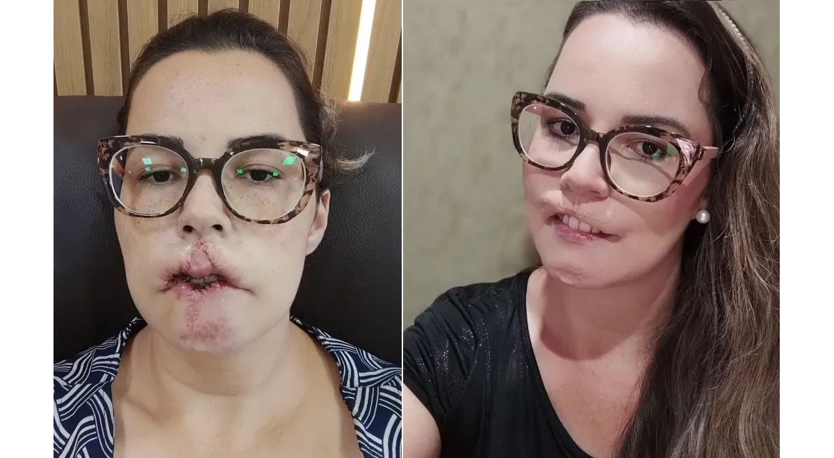 Foto: Influencer perde lábios e fica com rosto deformado após ...