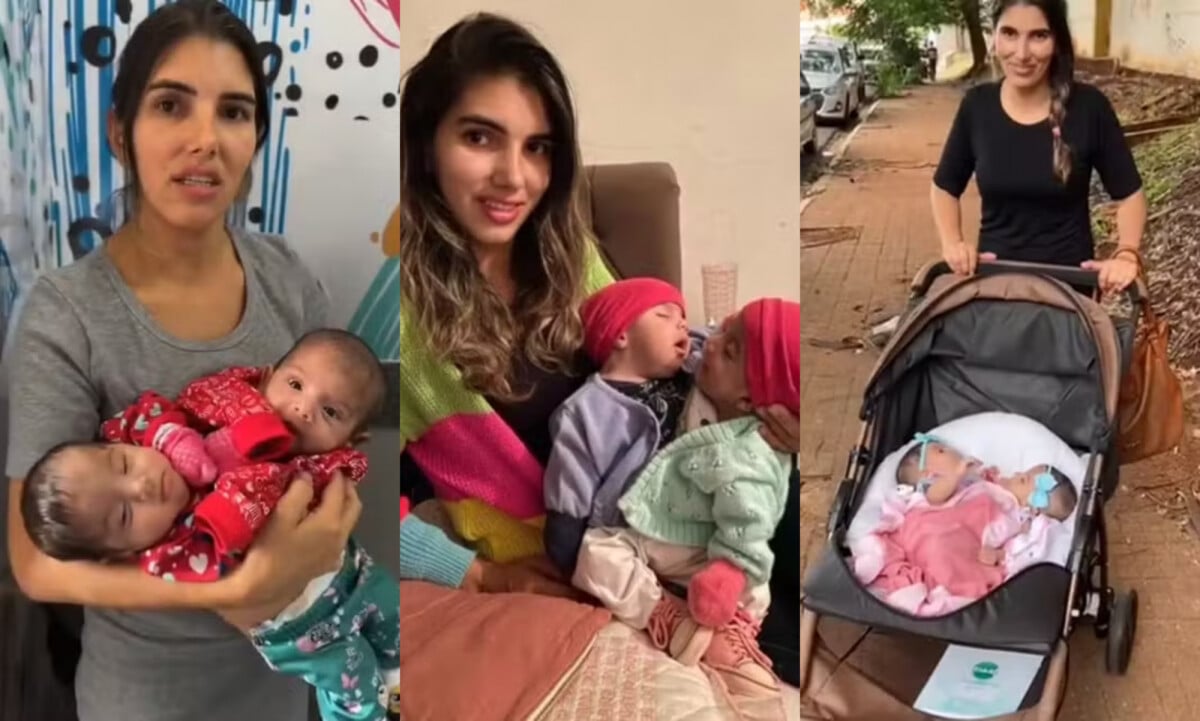 Foto: 'Cada uma ficará com uma perna': unidas pela bacia e genitália ...