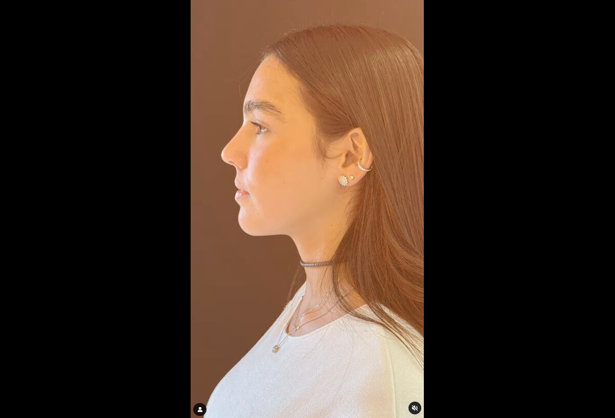 Foto: Duda Guerra, namorada de Benício Huck, mostrou o antes da ...