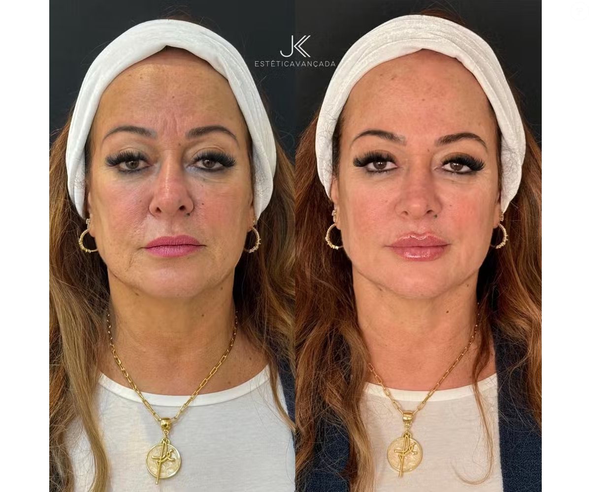 Foto: JK Estética Avançada: Nadine fez preenchimento labial, da região ...