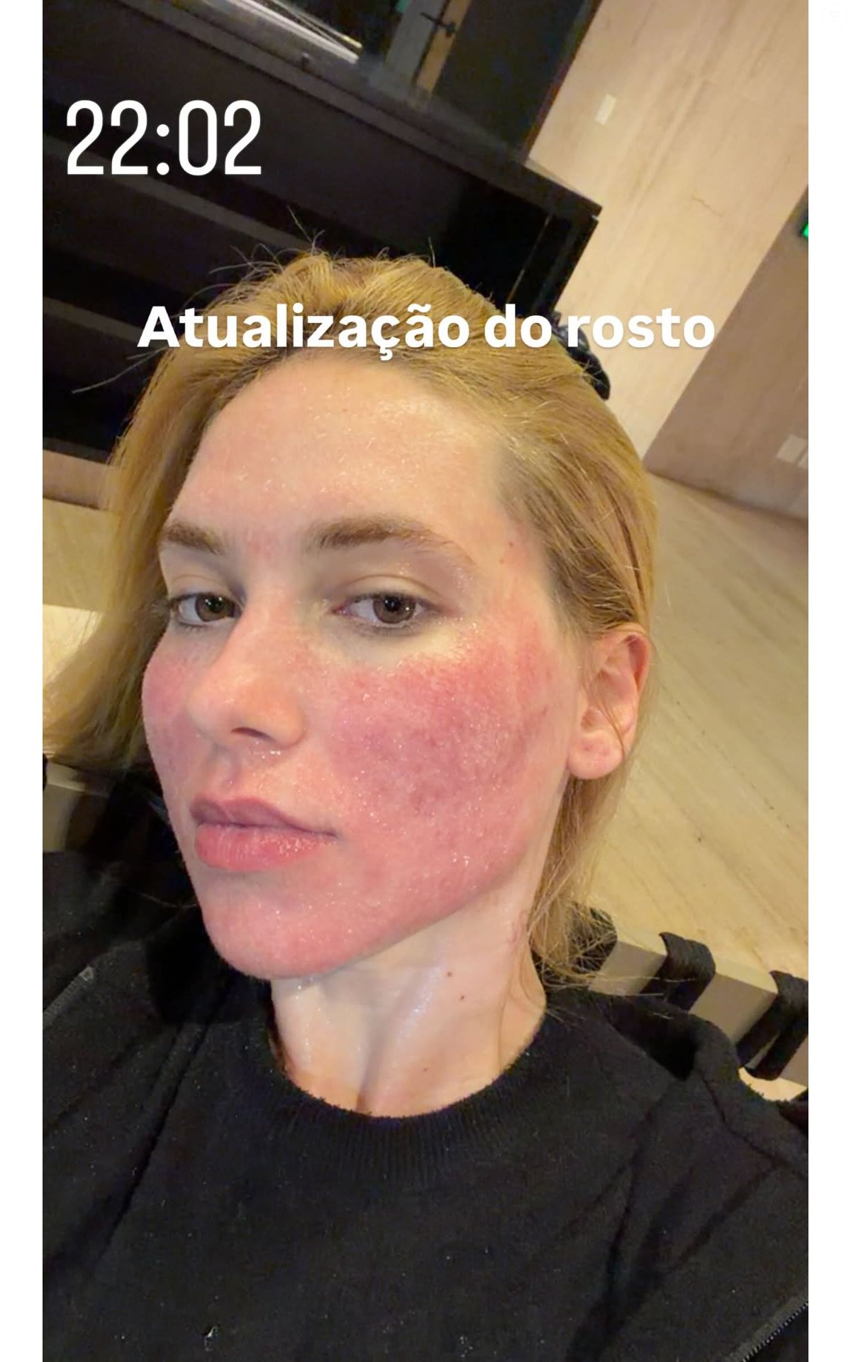 Foto: Virgínia está com o rosto vermelho e levemente inchado, o que é ...