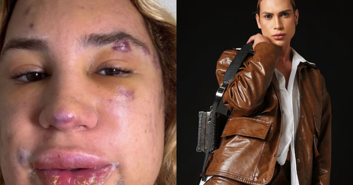 Influenciador Junior Dutra morre após complicações de procedimento ...