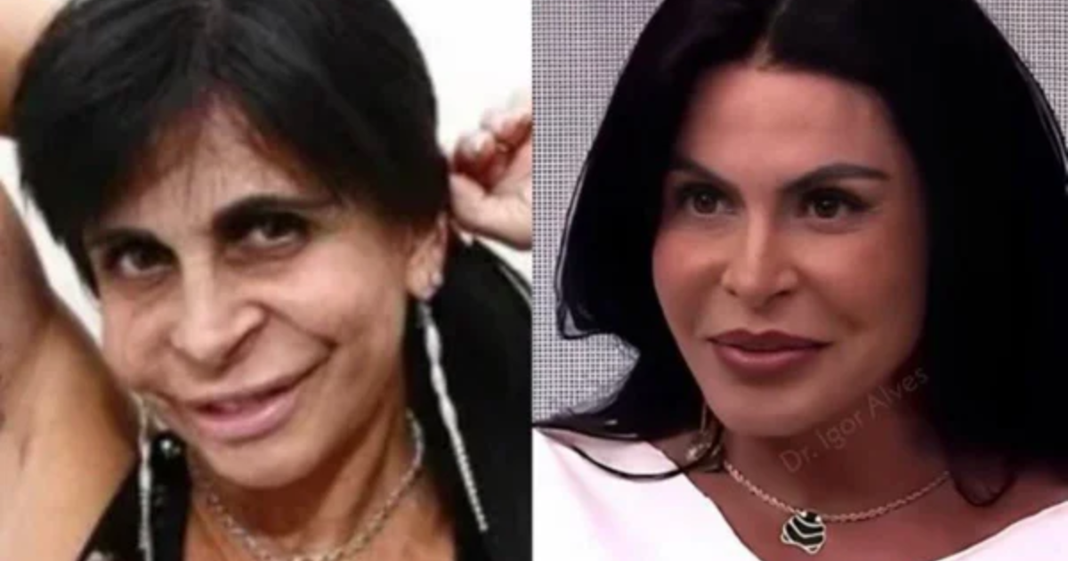 Antes e depois do 'novo rosto' de Gretchen viraliza e cantora rebate ...